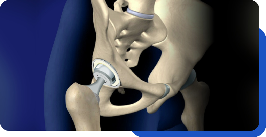 Total Hip Replacement Surgery In Dubai | Hip THR