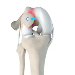 Patellar Tracking Disorder/Patellar Maltracking - OrthoPro Clinic
