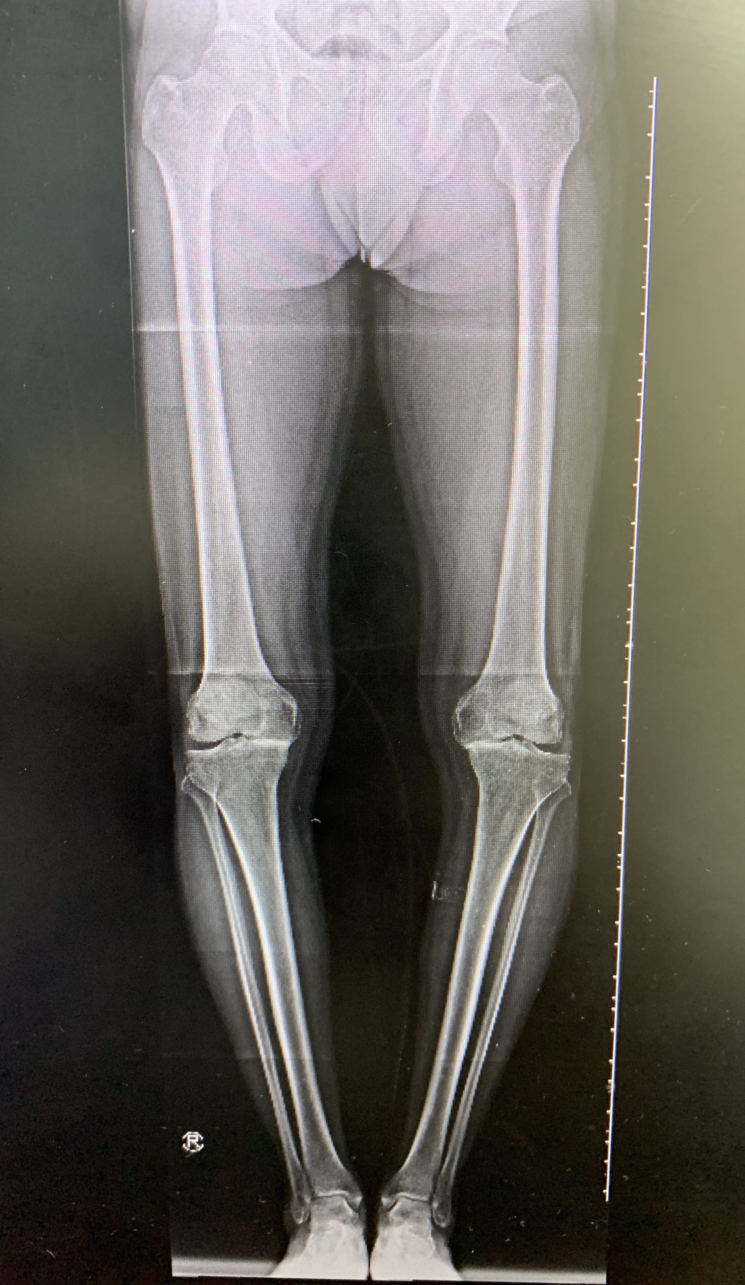 Partial Knee Replacement In Dubai | OrthoPro Clinic