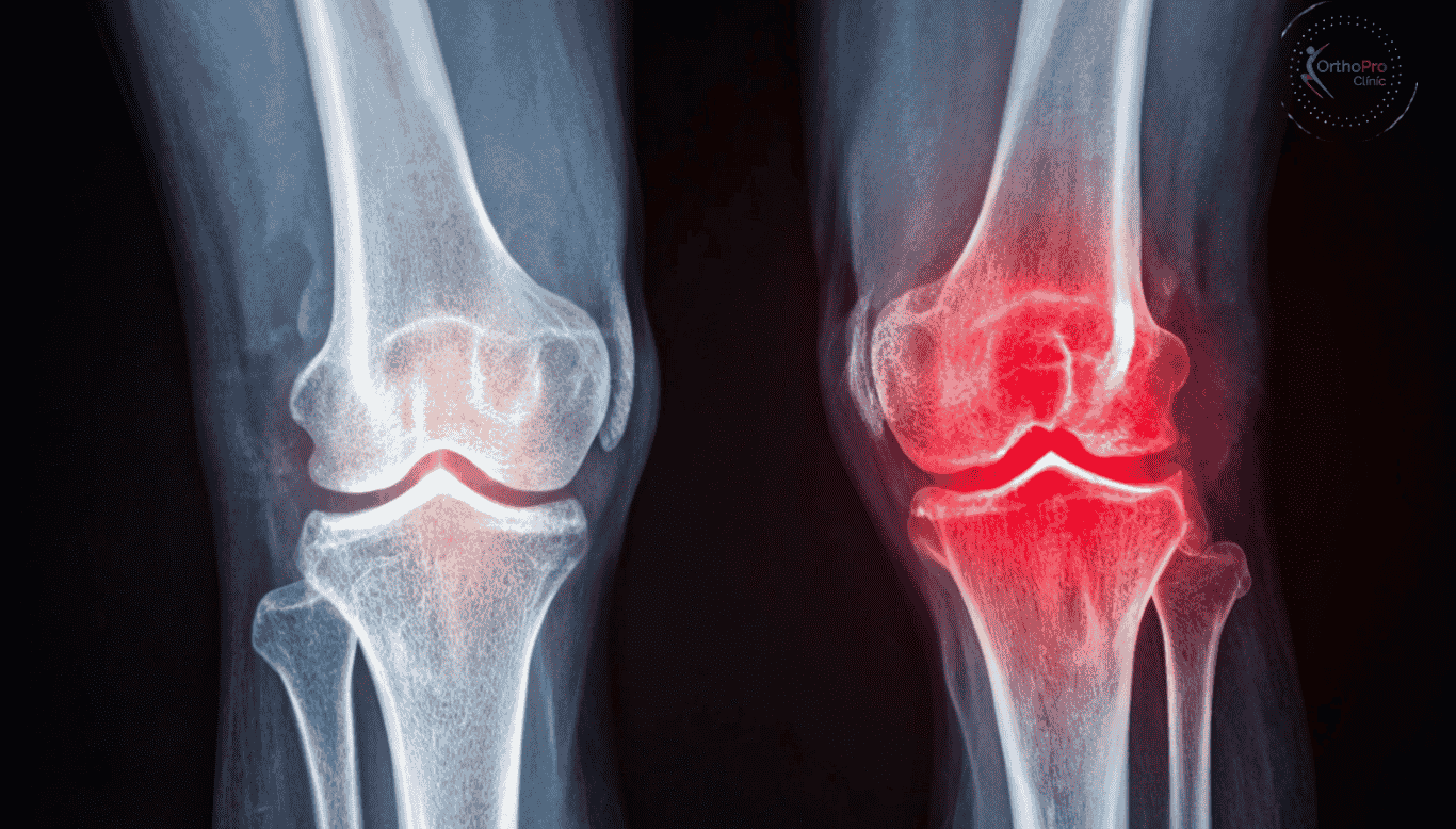 Patellar Tendonitis Treatment: Week-by-Week Recovery Guide